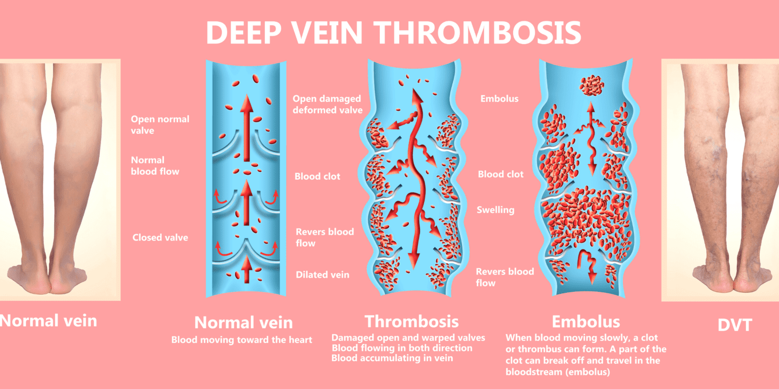 8 Hidden Health Risks Of Untreated Varicose Veins | Dr. Ross
